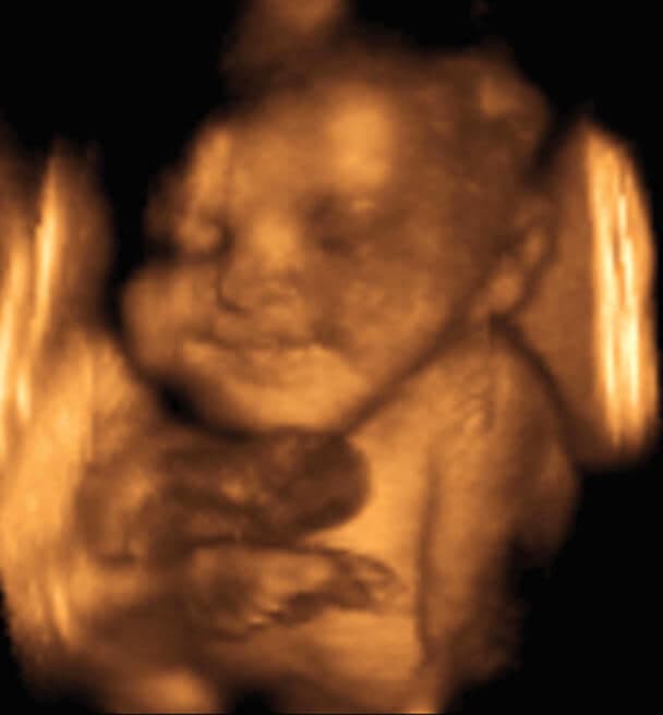 32 weeks and 3 days pregnant - Baby Fetal Progress, Ultrasound ...