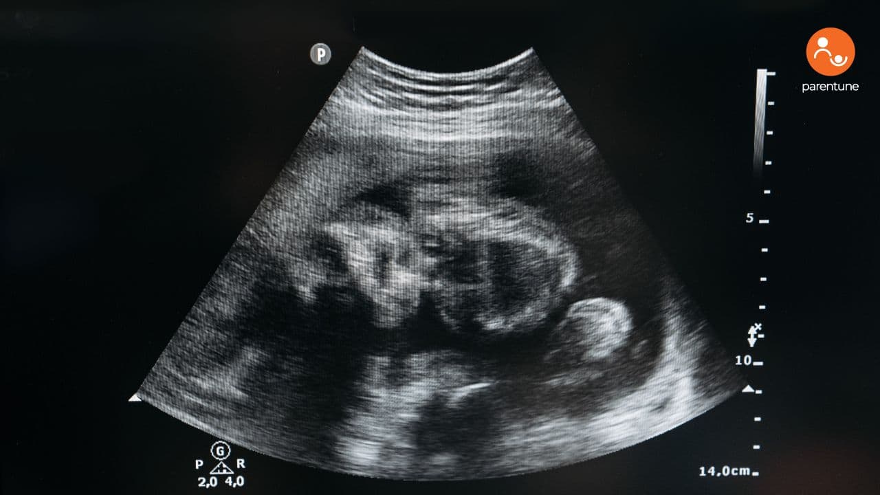 The Truth About Baby Hiccups In The Womb | Causes & When To Worry